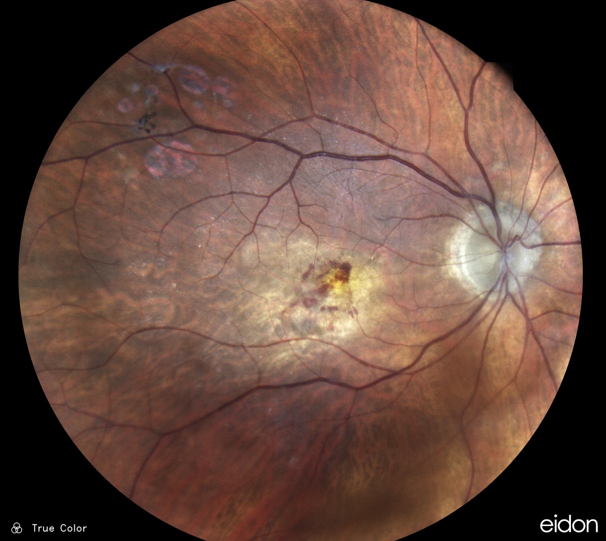 en savoir + DMLA(1) | OPHTALBI